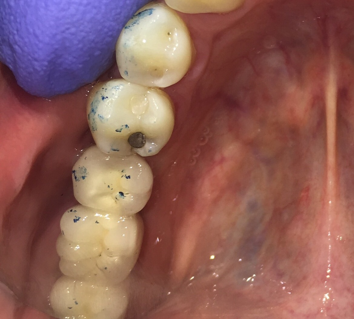 Regeneración ósea e implantes en el mismo acto.. – Dr. Darío Castro ...